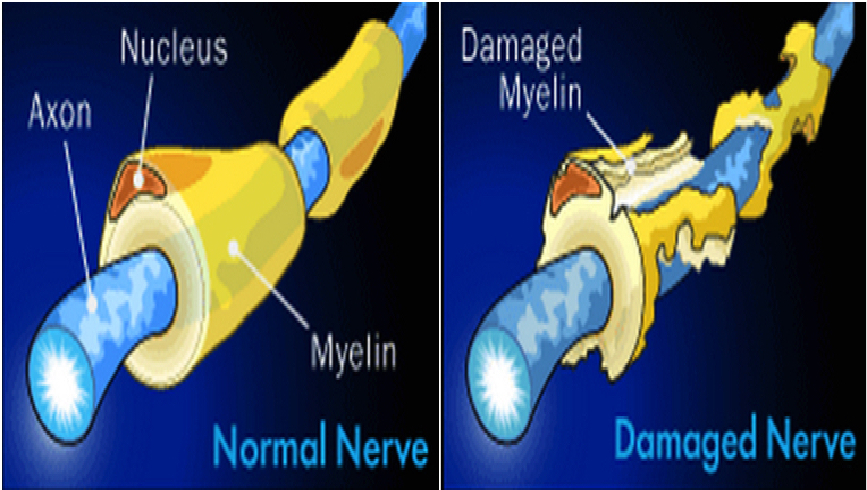 Nanoparticles Used to Deliver Myelin Repair Molecule